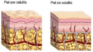 La celulitis: Qué es y cómo se evita